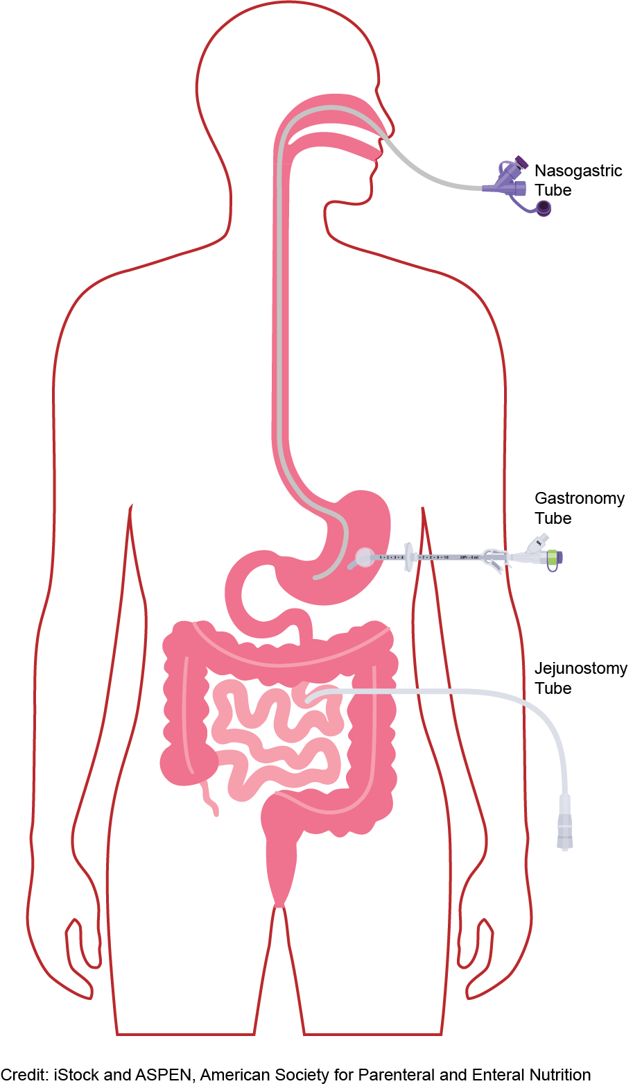 What is Enteral Nutrition? - ASPEN